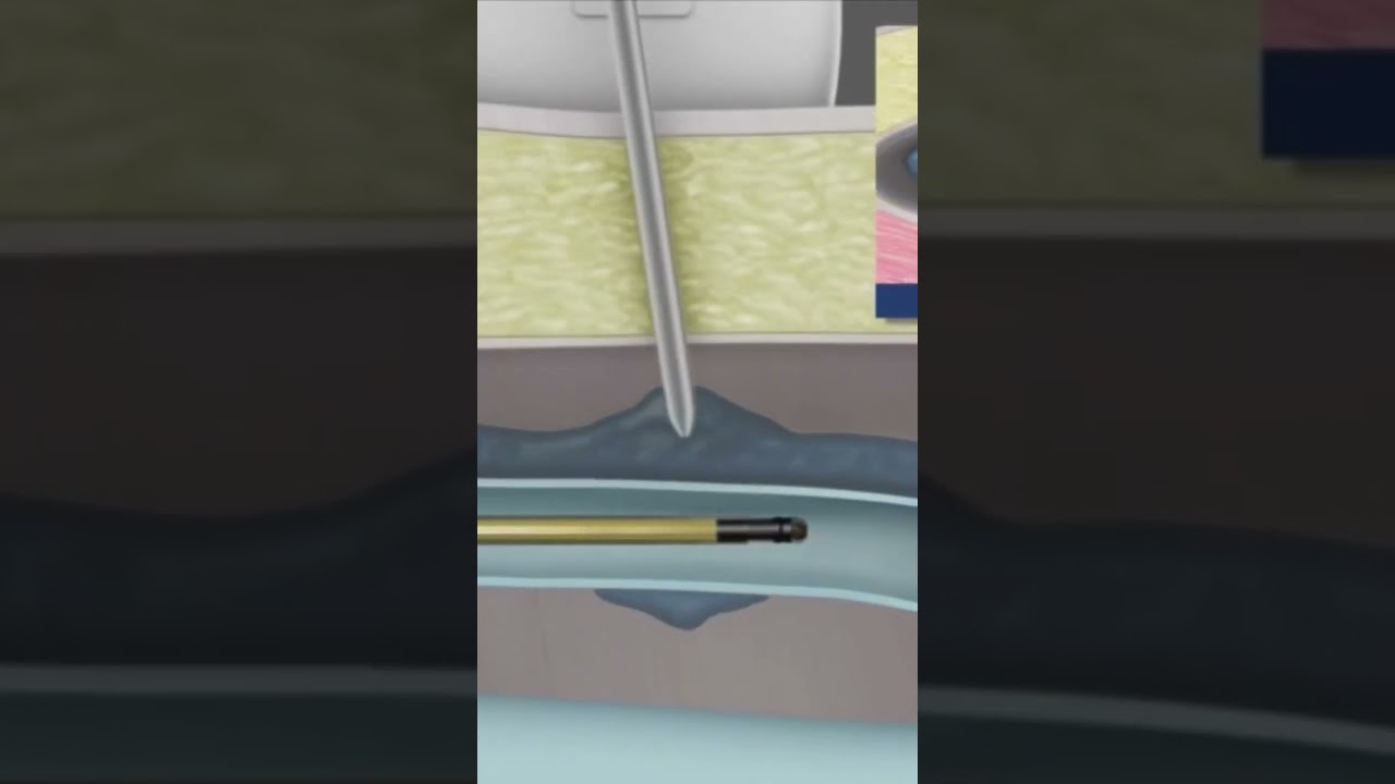 How radio frequency ablation treatment of the saphenous vein works? Varicose vein treatment