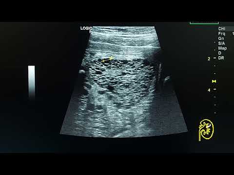 anhydramnios due to autosomal polycystic kidney disease