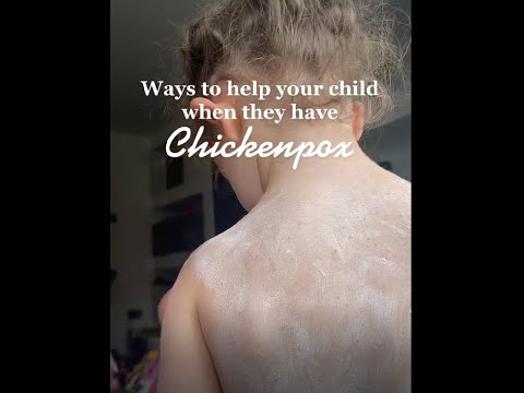What To Do If Your Child Has Chickenpox !