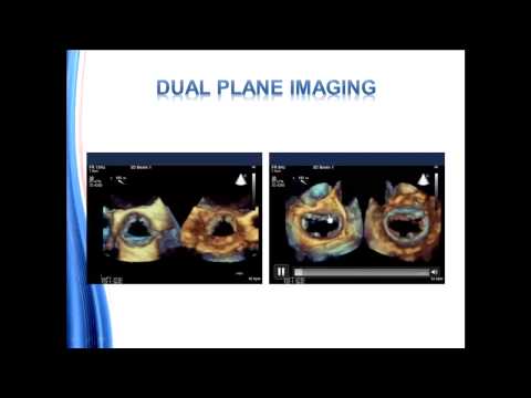 Guidelines for Performing a Comprehensive Transesophageal Echocardiographic Examination