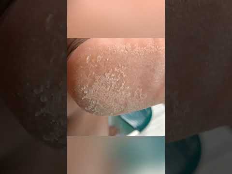 HYDROGEN PEROXIDE TRANSFORMED MY FEET #Shorts #feetvideo