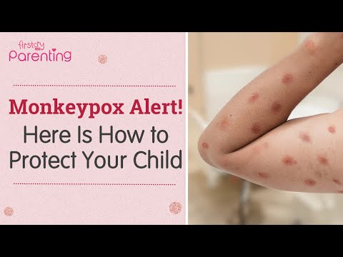 Monkeypox In Children - Symptoms, Risks and Safety Tips