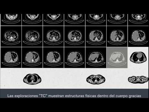 PET CT (Spanish subtitles)