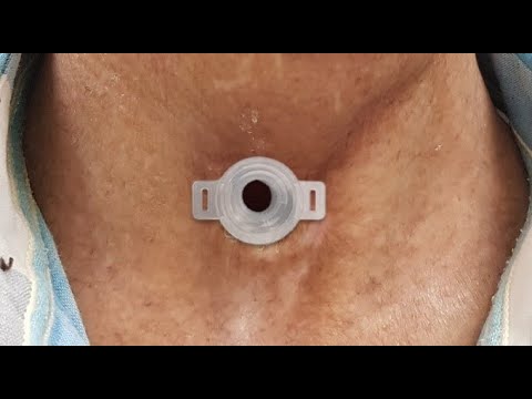 Laryngectomy Tube - Laryngeal Tube Latest Price, Manufacturers & Suppliers