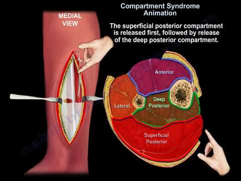 Acute and chronic leg Compartment Syndrome - Everything You Need To Know - Dr. Nabil Ebraheim