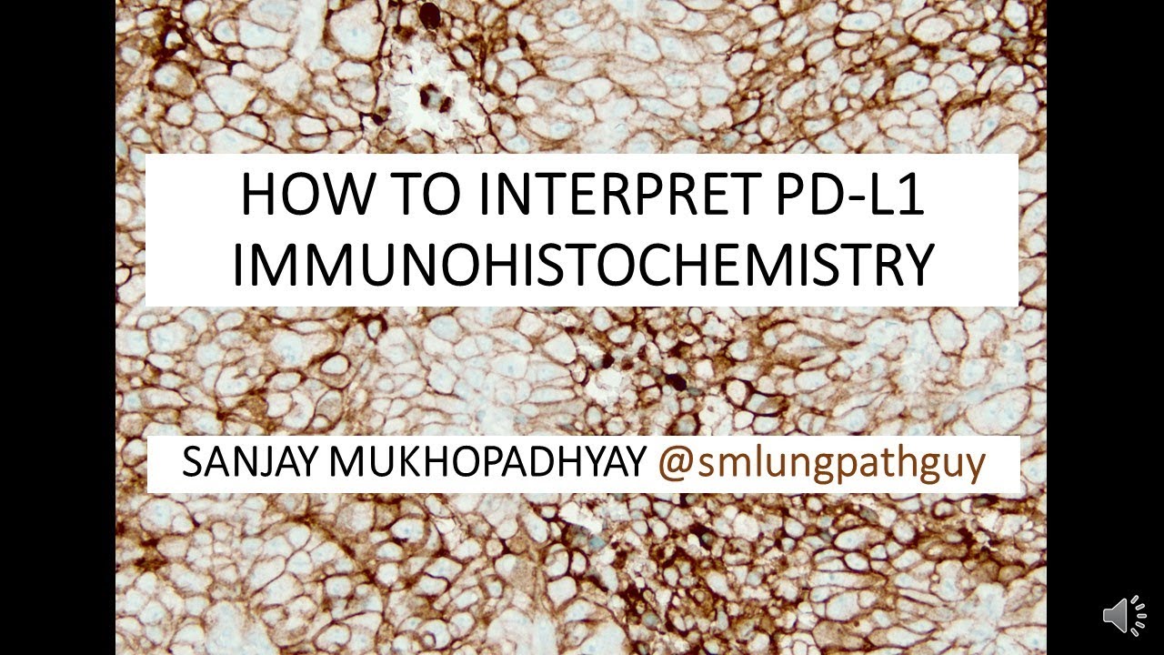 How to interpret a PD-L1 immunostain