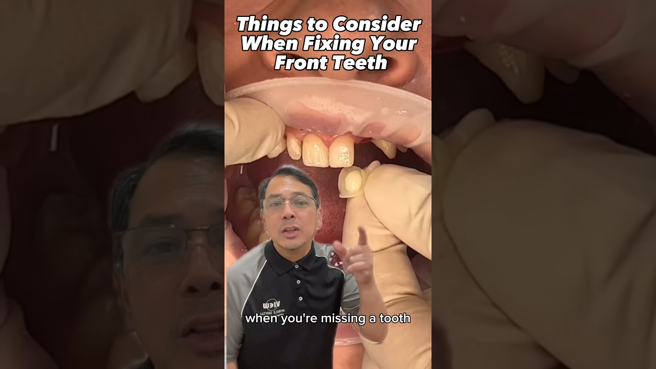 Fixed Bridge & Composite Bonding on Anterior Teeth | In Office to Hands On Dental Training #shorts