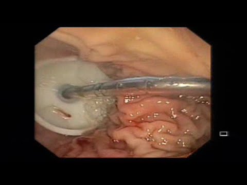 Percutaneous Endoscopic feeding tube placement through PEG tube