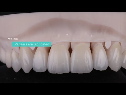 Achieving symmetry with iTero™ scanner: Dr. Glassman's veneer success story