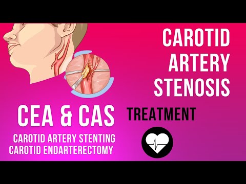 Carotid Artery Stenosis - Treatment - Carotid Endarterectomy (CEA) , Carotid artery stenting (CAS)