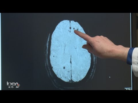 A new Mayo Clinic study that finds disturbing numbers of CTE damage in much younger athletes