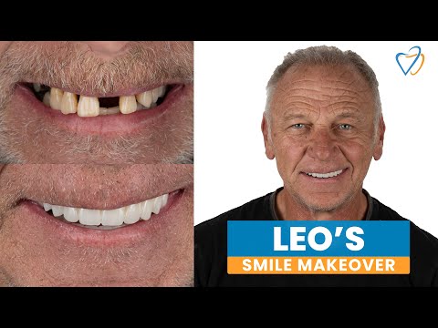 How All-on-X Dental Implants Restored Leo's Smile | VDC Customer Story #57: Leo