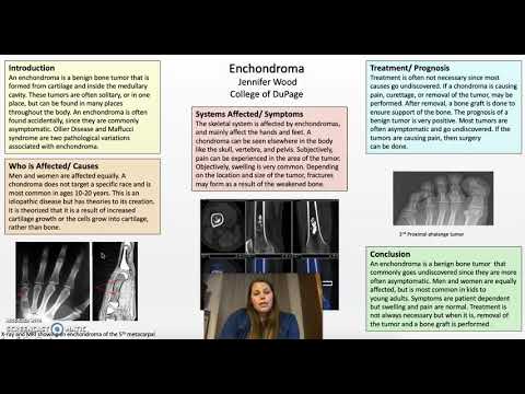 Radiography - Enchondroma