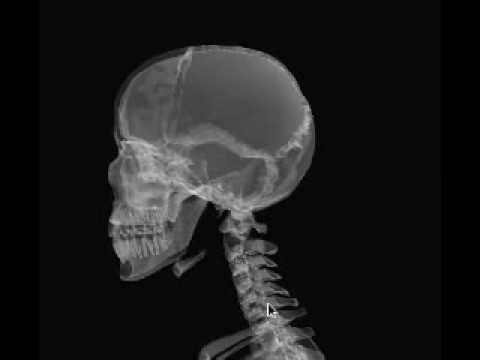 Axiolateral Oblique Mandible