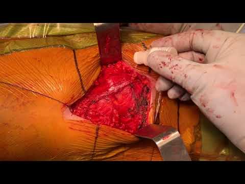 Dr. Khalid Yousuf utilizes CellerateRX® Surgical Powder in a Total Hip Replacement