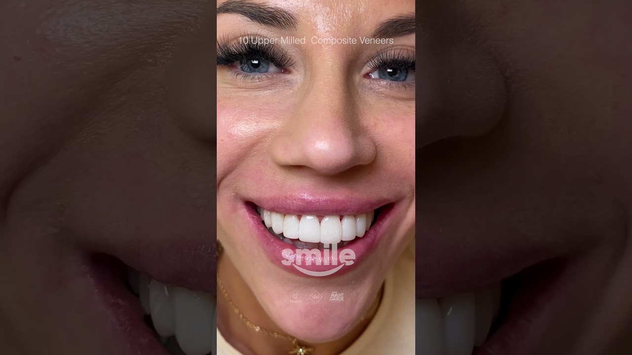 10 Upper Milled Composite Veneers #shorts #Composite Veneers #beforeandafter #dental #satisfying