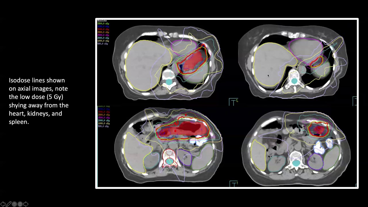 Dr. Bouthaina Dabaja: Radiation Therapy for Gastric Lymphoma