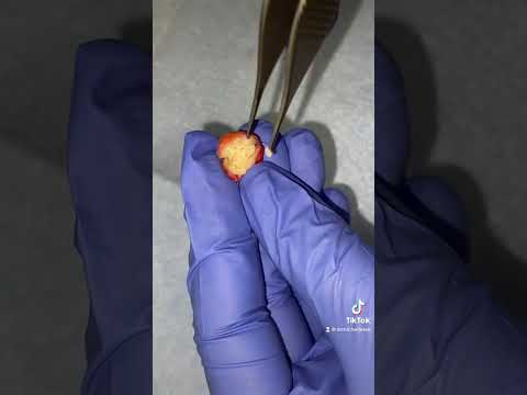 5 effective natural remedies to cure sebaceous cysts best ho Watch HD ...