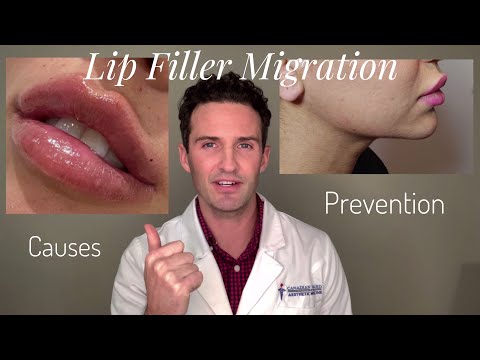 Lip Filler Migration: Causes & Prevention