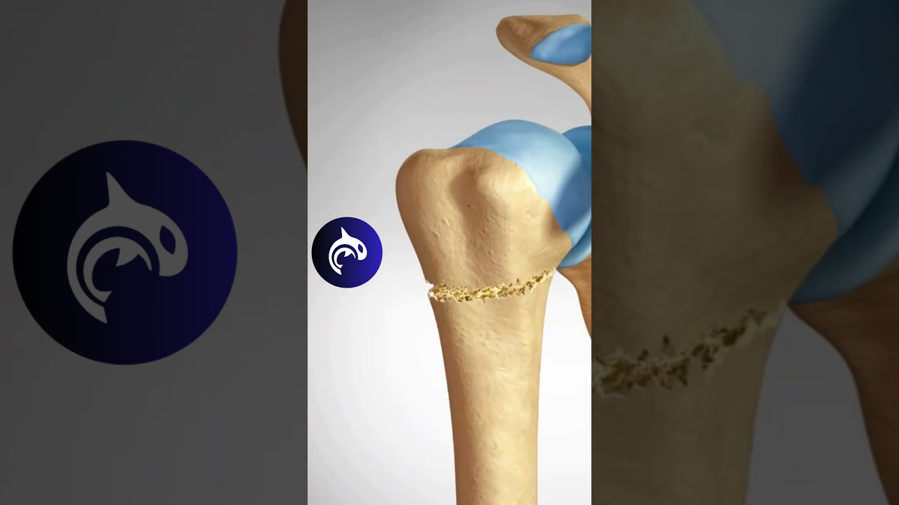 Shoulder Fracture: See Different Proximal Humeral Fractures in 3D #fracture #shoulder