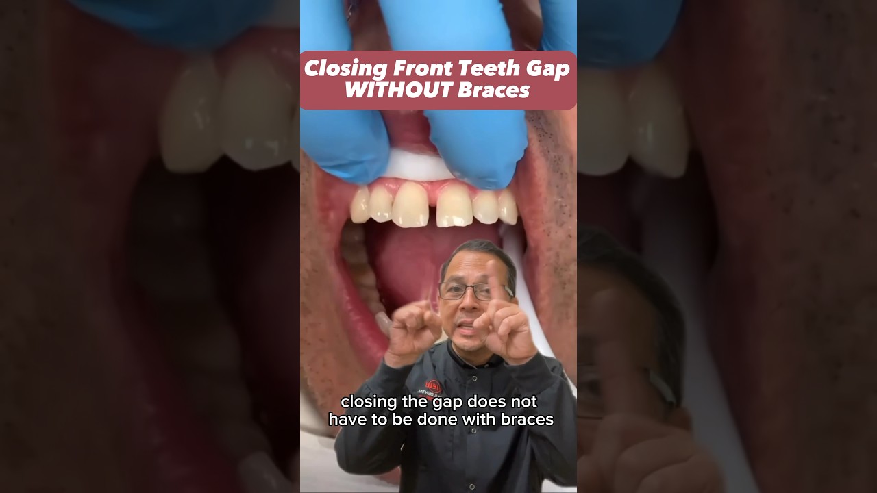 Fixing Front Teeth Gap in ONE Appointment EXPLAINED | In Office to Hands On Dental Training #shorts