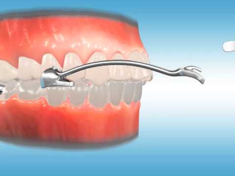 Carriere® Motion Appliance being placed with an Essix appliance