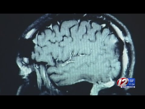 Brown Doctor: Concussions, CTE Not the Same Thing