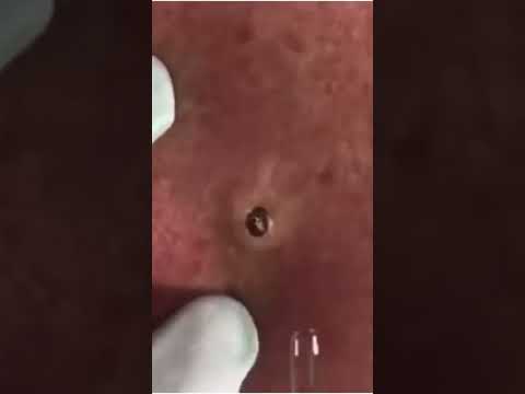 Giant blackheads 👩🏻⚕️😁 “Winer's dilated pore”