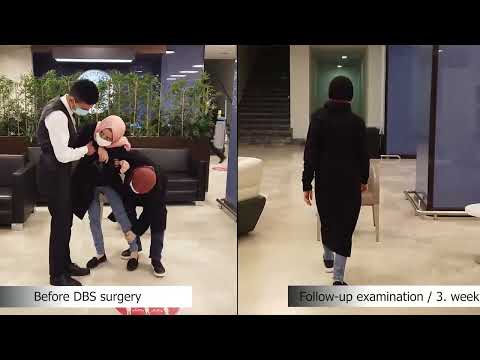Change of Parkinson Patient Sanaa Aljaghali with DBS Treatment | Doç. Dr. Ali ZIRH