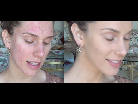 Almost Flawless Everyday Acne Foundation Routine DiamondsAndHeels14 Cassandra Bankson