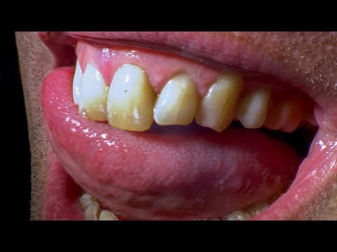 What Happens When You Don't Brush Your Teeth? | Earth Science