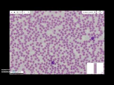 Microangiopathic Haemolytic Anaemia