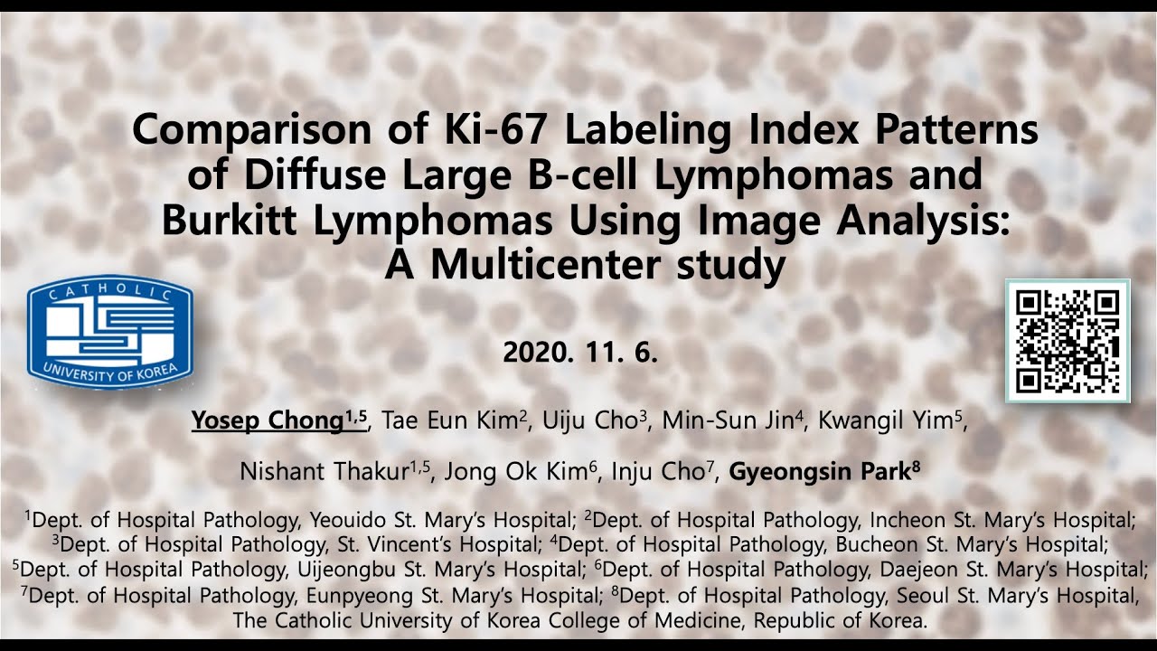 Ki-67 labeling index patterns between DLBCL vs. Burkitt lymphoma