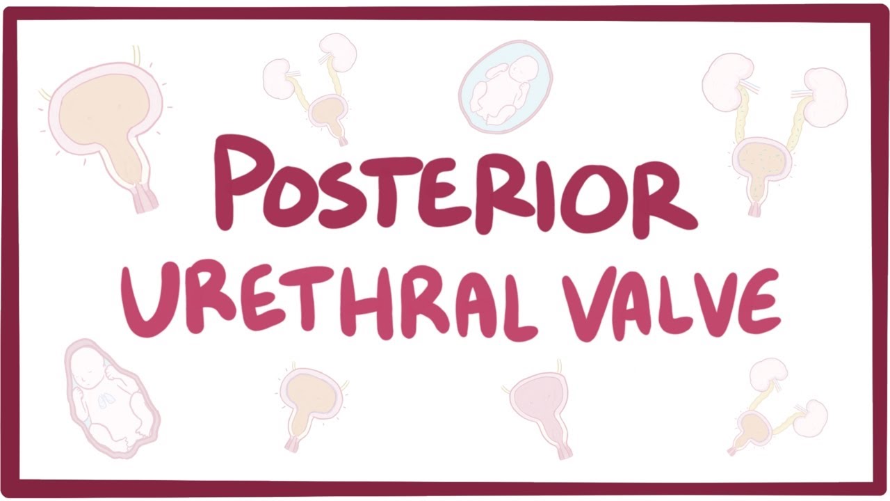 Posterior urethral valve (PUV) - causes, symptoms, diagnosis, treatment, pathology