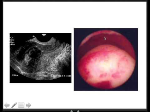 DAROGA Abnormal Uterine Bleeding. Part 2: treatment options