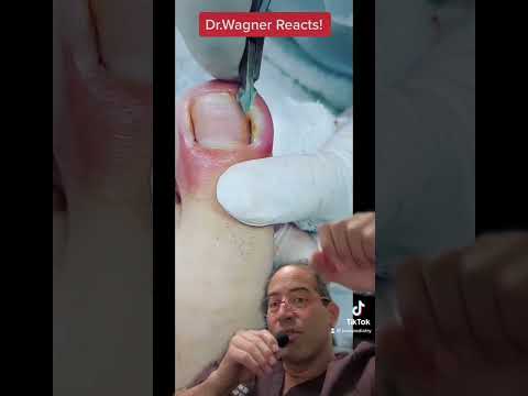 SUPER ANGRY INGROWN TOENAIL WITH ABSCESS😢#shorts #ingrown_toenail