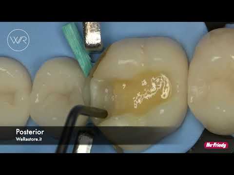 1 - How to use the 3ssential kit by WeRestore on Class II case
