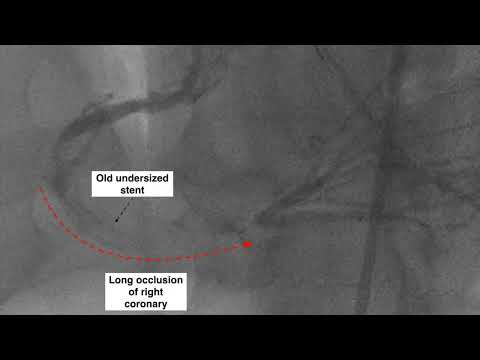 Chronic total occlusion (CTO) PCI to occluded right coronary artery (Central Heart)