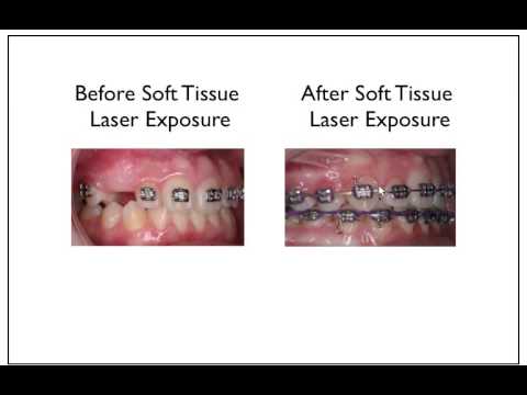 Orthodontist Laser TAD - Dr. Matthew David McNutt, Orthodontist