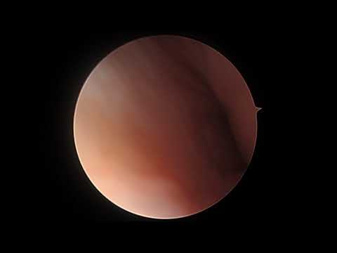 Left Knee diagnostic arthroscopy 12.7.20 VF