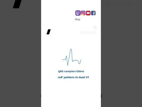 criteria for RBBB #ecg #ecginterpretation #shorts #viralshorts