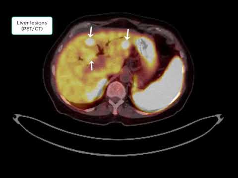 Neuroendocrine Tumor (Gallium-68 DOTATATE PET/CT)