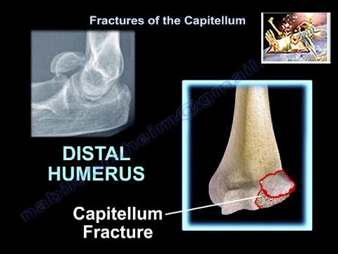 Fracture of the Capitellum – Dr. Nabil Ebraheim's Blog
