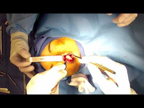 Open Rhinoplasty - (Part 3) Evaluation of Nasal Tip Cartilages Chevy Chase Maryland