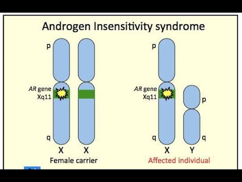 Diagnosis and embryological basis of Androgen insensitivity syndrome (testicular feminizing)