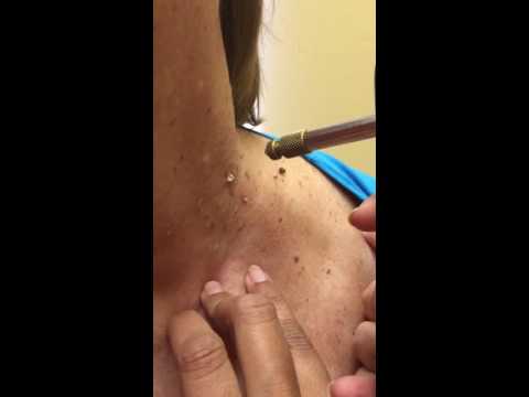 Skin tag removal