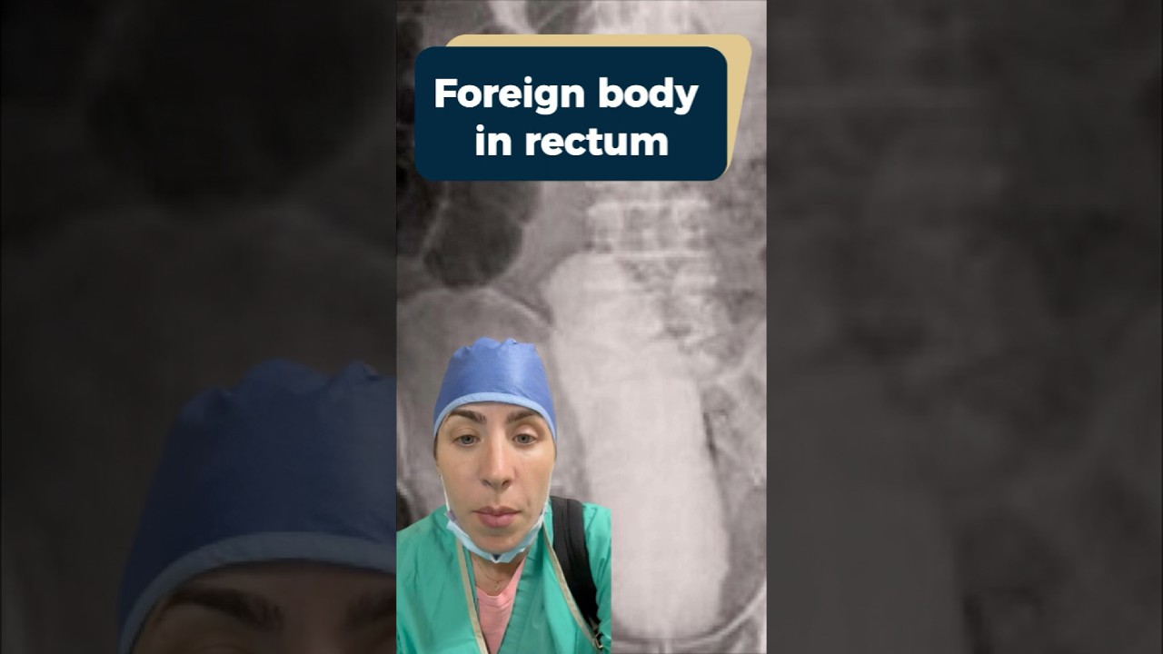 Foreign object in the rectum: what happens if it doesn’t come out