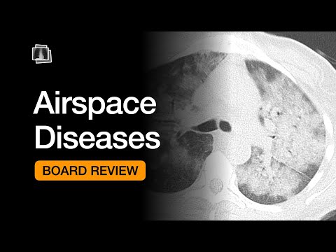 Airspace Diseases | Chest Radiology Board Review