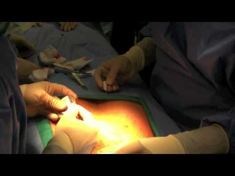 Dr. Atallah Describes Sacral Nerve Stimulator "SNS" Implantation for Fecal Incontinence