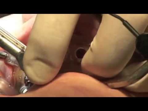 Nobel Guide Implant Surgery by Drs. Edward Gottesman and Kunal Lal